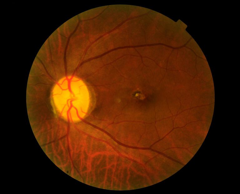 Cupped Disc - Mr Shahram Kashani