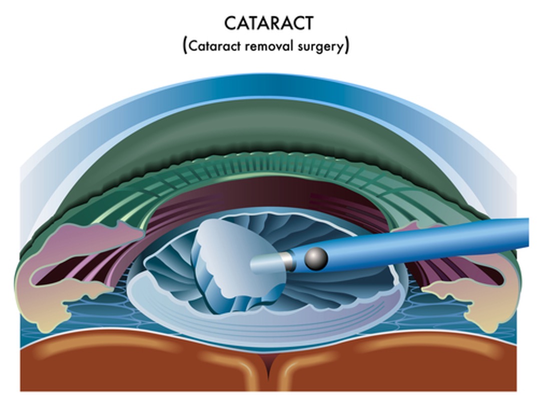 Cataracts and how do they affect my vision - Mr Shahram Kashani